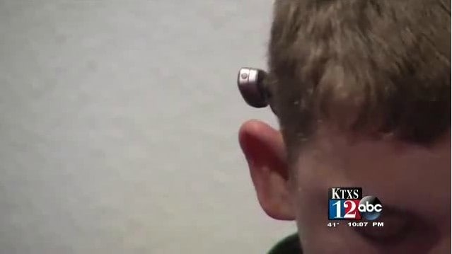 Cochlear in the News: Texas teen receives first Baha device in his area ...