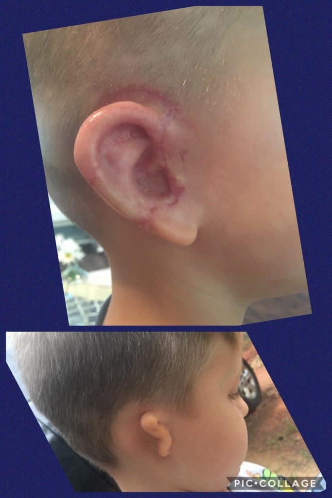Mom gets tattoo of Baha Sound Processor for son with ear malformation ...