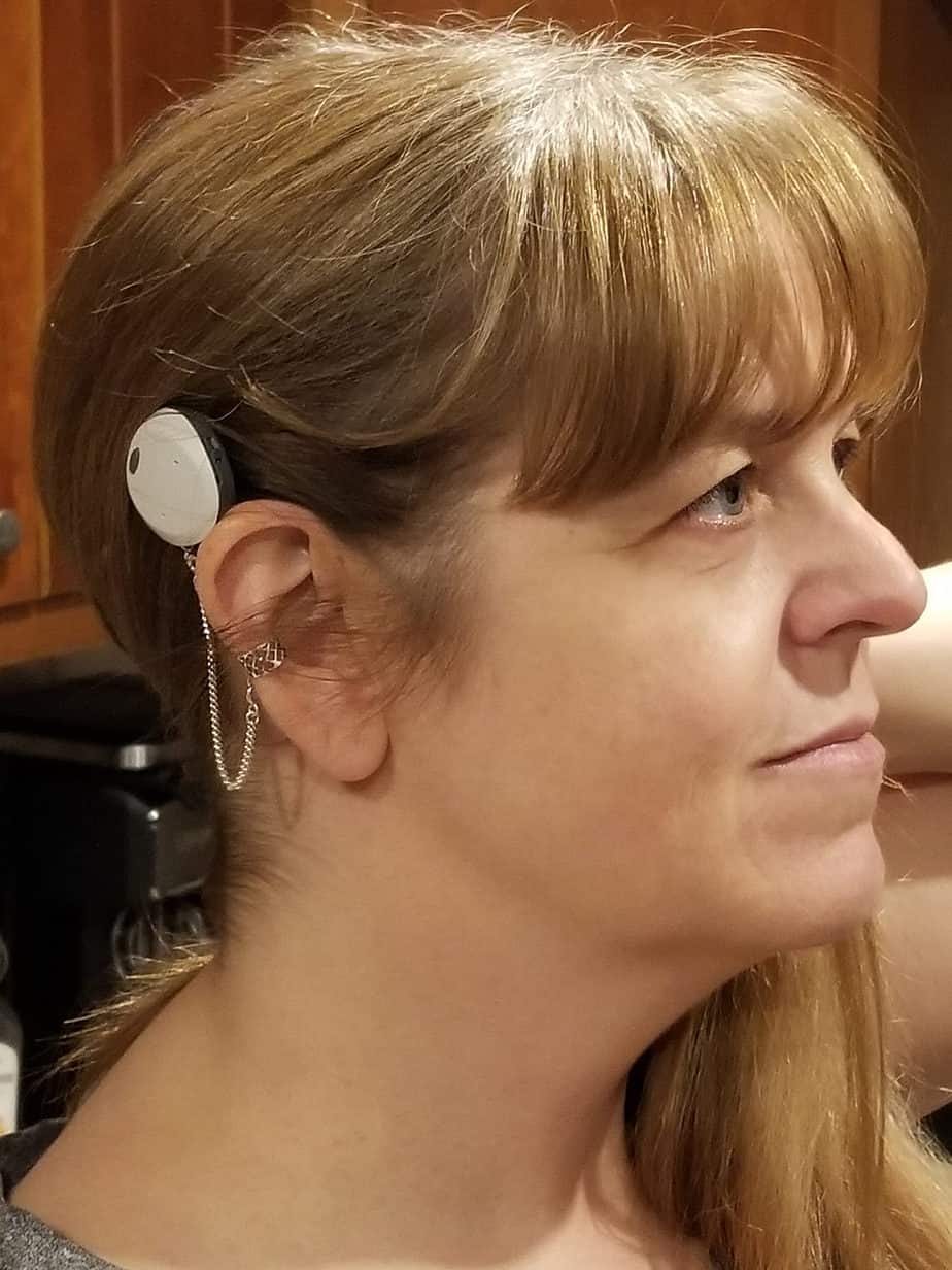 Woman with single-sided profound hearing loss gets the Osia System