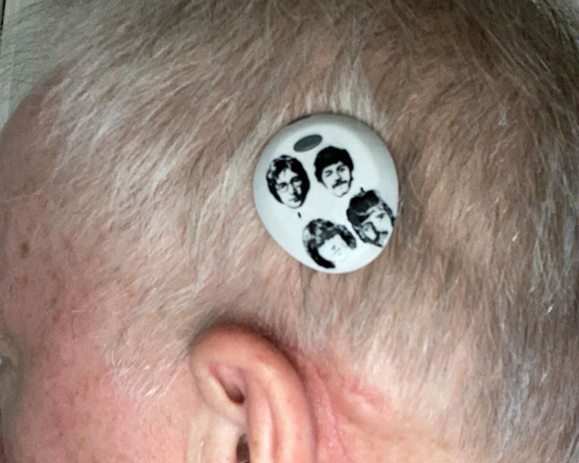 Osia 2 System helps musician's career after single-sided deafness