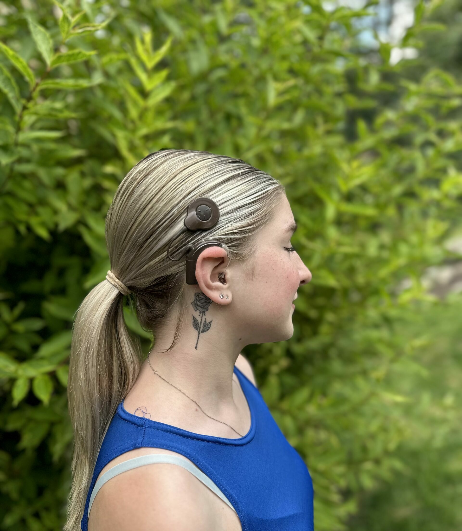 Cochlear implant helped severe hearing loss from Cystic fibrosis