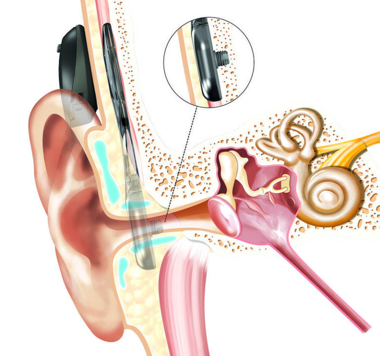 The difference between conductive and sensorineural hearing loss