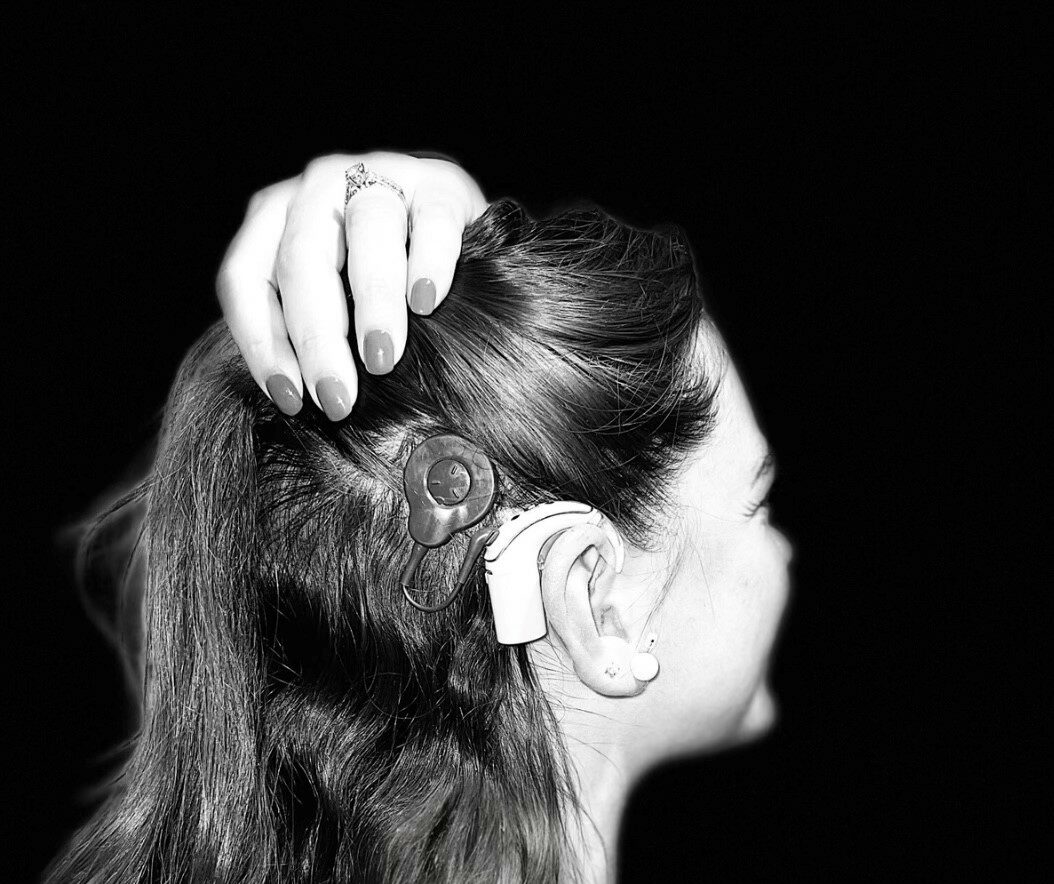 Mia’s cochlear implant empowered her bilateral profound deafness