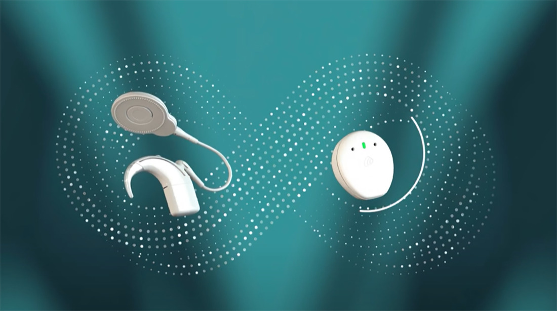 World’s First and Only Smart Cochlear Implant System by Cochlear